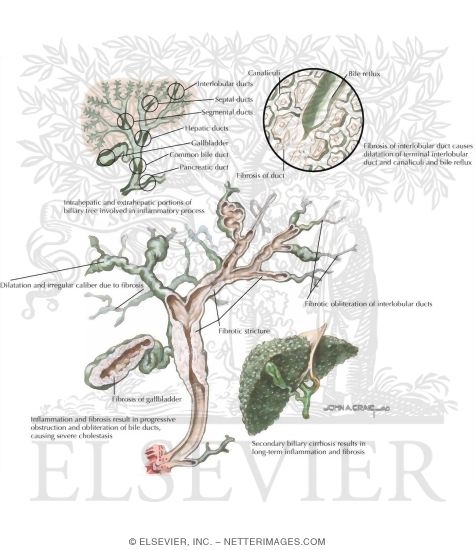 Diseases of the Biliary Tract