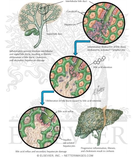 Diseases of the Biliary Tract