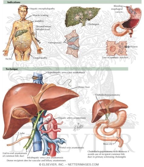 choledochojejunostomy indications