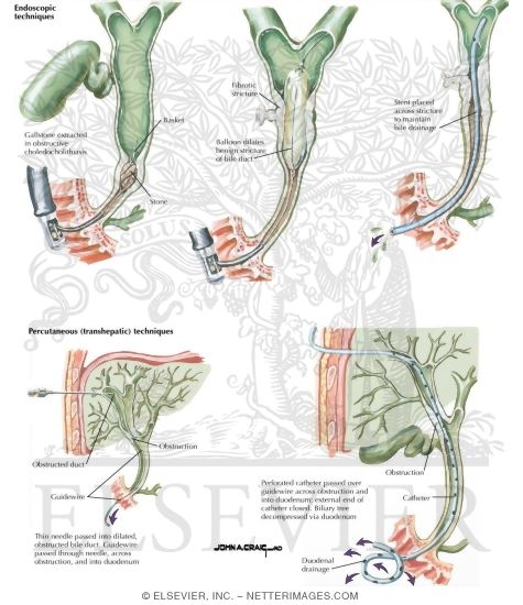 Mechanical Decompression Techniques