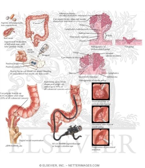 Neoplasms of the Large Bowel: Screening and Treatment of Colon Polyps