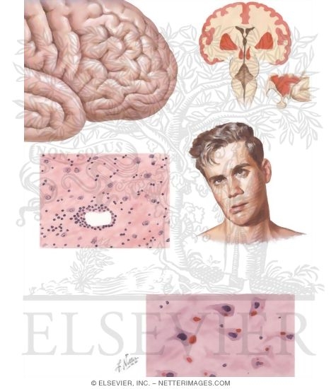 Epidemic Encephalitis And Rabies