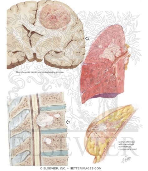 Tumors Metastatic to Brain and Spine
