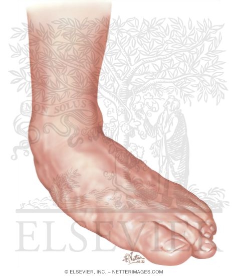 Static Disorders of Ankle and Foot