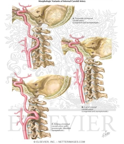 Morphologic Variants of Vertebral and Common Carotid Arteries
