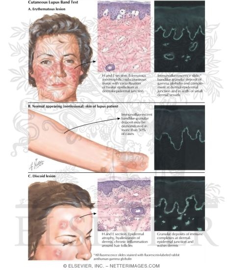 Cutaneous Lupus Band Test