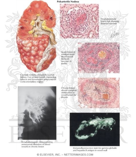 Polyarteritis Nodosa