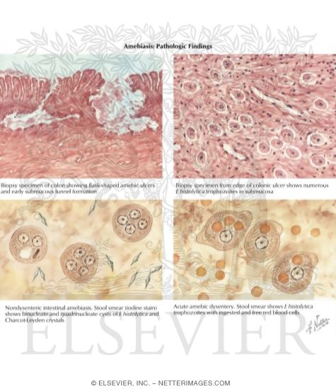 Amebiasis: Pathology and Diagnosis