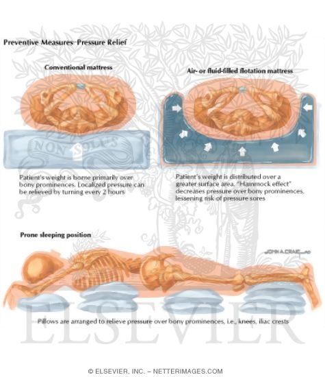 Preventive Measures - Pressure Relief