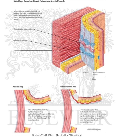Skin Flaps Based on Direct Cutaneous Arterial Supply