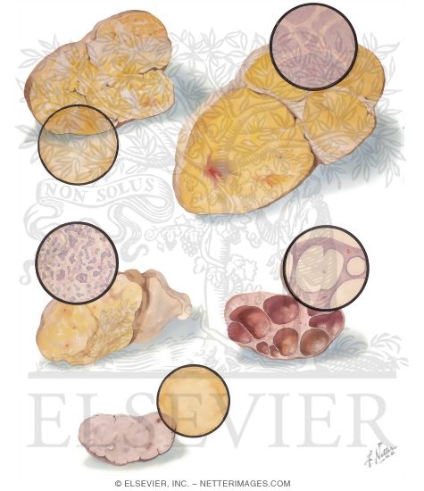 Pathology of the Ovary