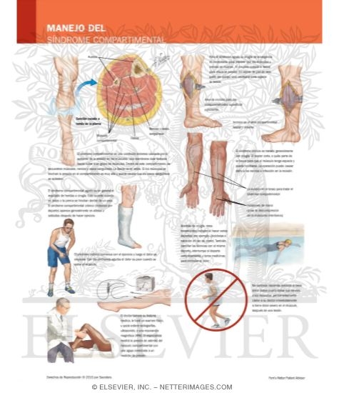 Managing Your Compartment Syndrome