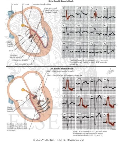 Right Bundle Branch Block