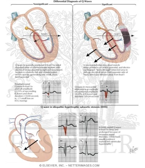 Q Waves: Differential Diagnosis