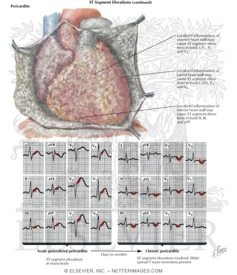 ST Segment Elevations