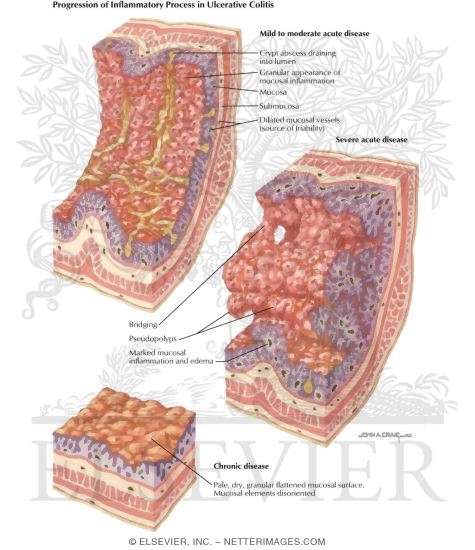 Inflammatory Bowel Disesae: Progression of Inflammatory Process In ...