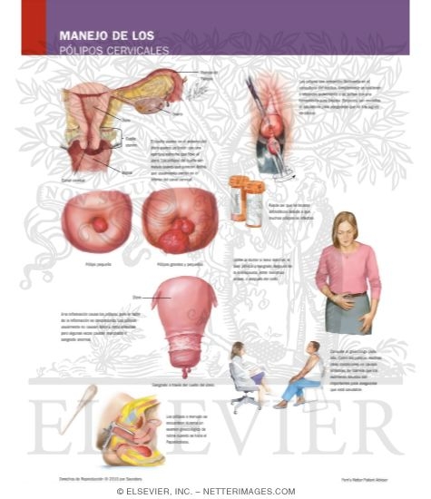 cervical polyp pathway