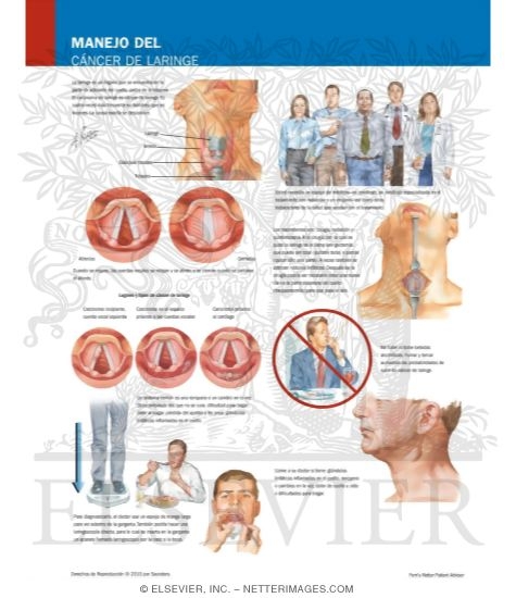 Managing Your Laryngeal Cancer