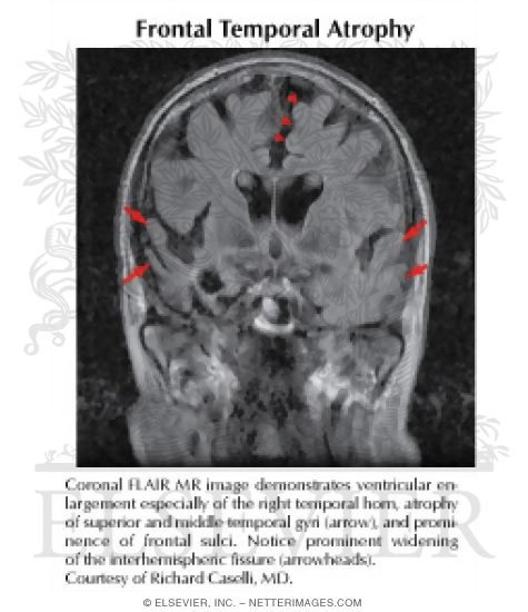 Frontal Temporal Atrophy