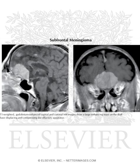 Subfrontal Meningioma