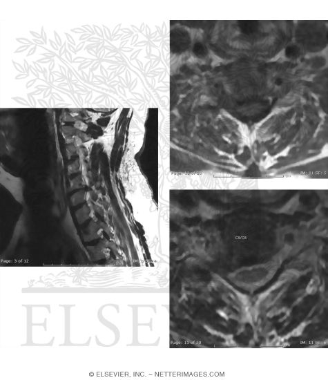 Cervical Disc Herniation