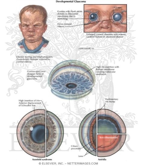 Developmental Glaucoma
