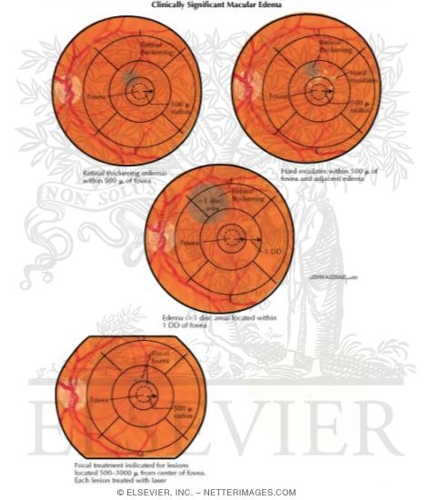 Clinically Significant Macular Edema