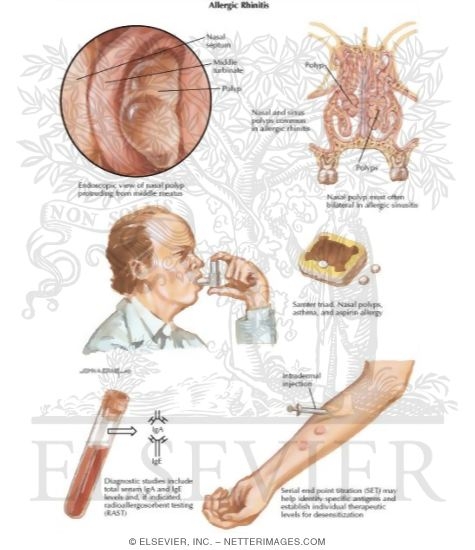 Allergic Rhinosinusitis