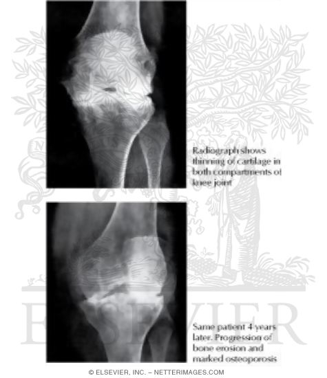 Radiographic Changes In Rheumatoid Arthritis (RA)