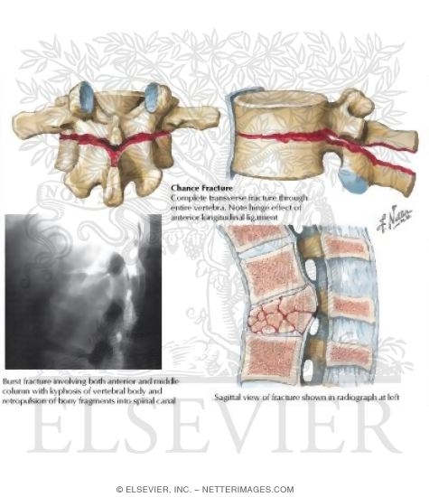 Stable Fracture Vertebral Dislocation and Fractures