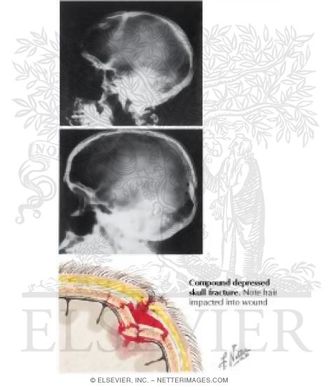 Compound Depressed Skull Fractures