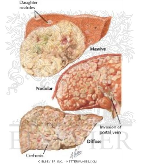 Tumors II - Primary Hepatic Carcinoma