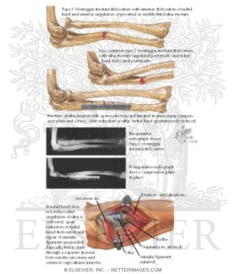 Fracture of Shaft of Ulna