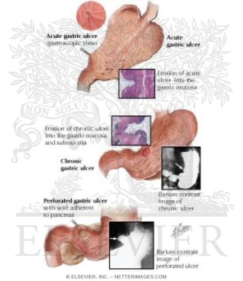 Peptic Ulcer Disease
