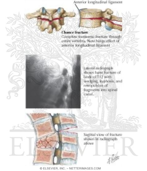 Stable Fracture Vertebral Dislocation and Fractures