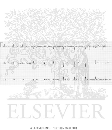 Normal Electrocardiography (ECG)
