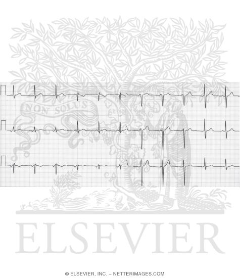 Ecg Litfl Sinus Ekg Basics Diagnosis Syndrome Ventricular Lead Degree ...