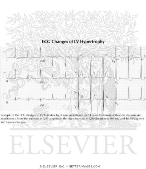 Electrocardiography ECG Changes of LV Hypertrophy