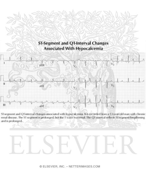 ST-Segment and QT-Interval Changes Associated With Hypocalcemia
