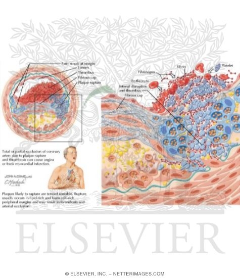 Atherogenesis: Unstable Plaque Formation