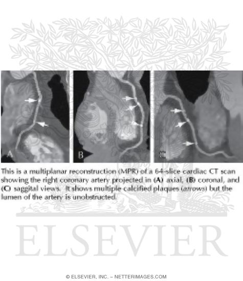 Computed Tomography (CT) Coronary Angiography