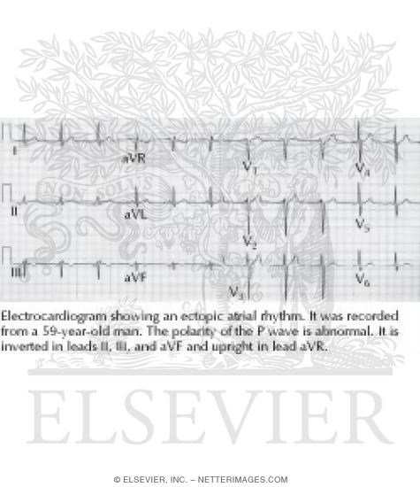 Ectopic Atrial Rhythm