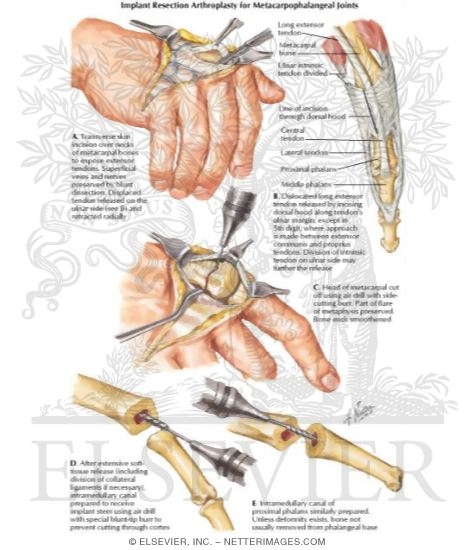 Implant Resection Arthroplasty for Metacarpophalangeal Joints
