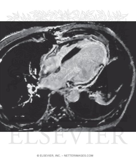 Cardiac Magnetic Resonance Imaging – Transmural and Nontransmural Scars