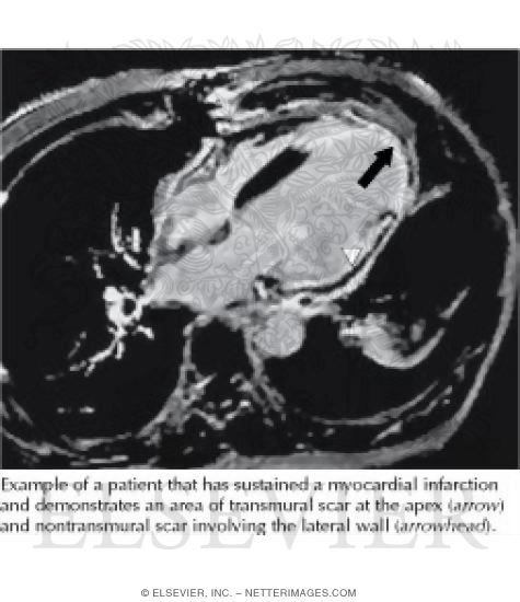 Cardiac Magnetic Resonance Imaging – Transmural and Nontransmural Scars