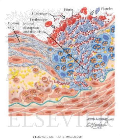 Atherogenesis: Unstable Plaque Formation