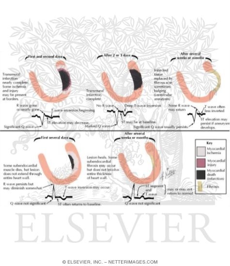 Manifestations of Myocardial Infarction