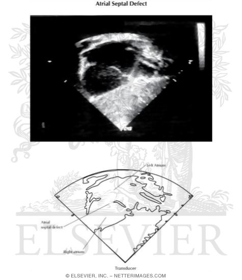 Atrial Septal Defect