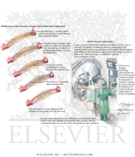 Acute Percutaneous Coronary Intervention (PCI) In the Management of ...