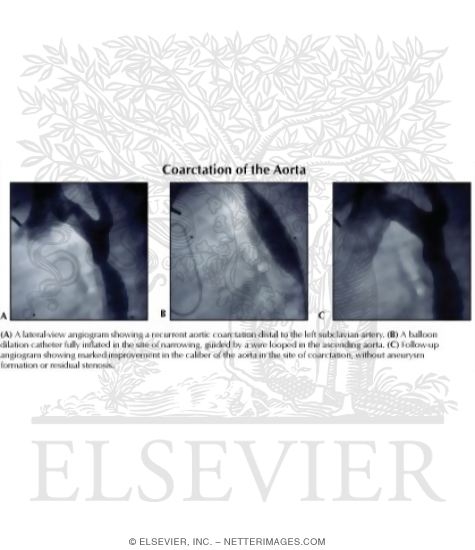Coarctation of the Aorta